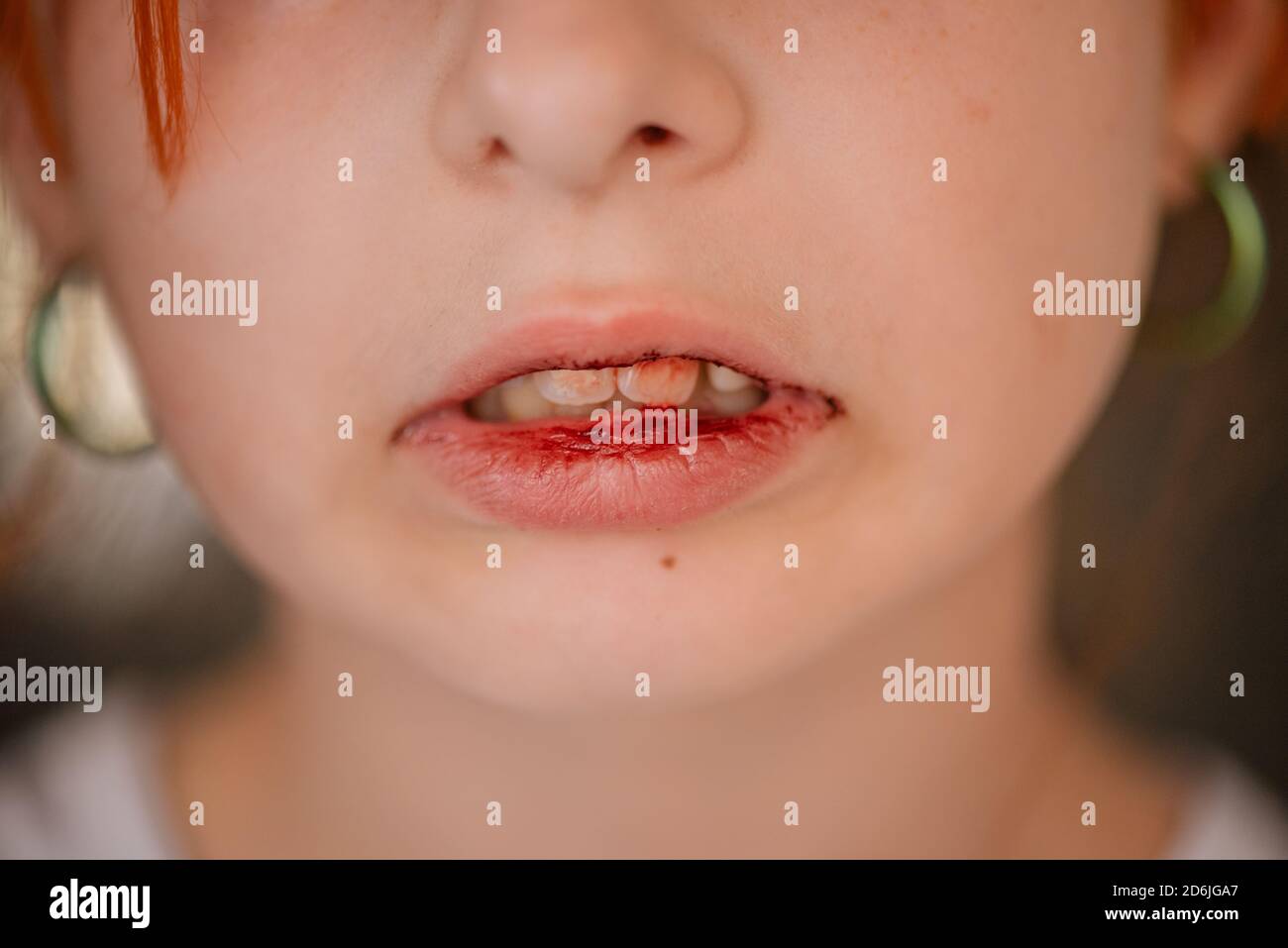 little girl with a broken lip. Girl with a broken lip Stock Photo - Alamy