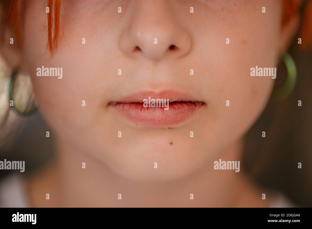little girl with a broken lip. Girl with a broken lip Stock Photo - Alamy