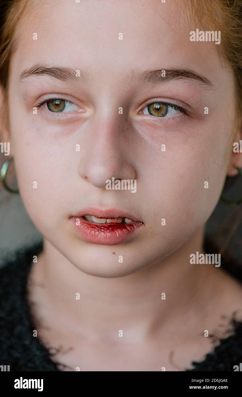 little girl with a broken lip. Girl with a broken lip Stock Photo - Alamy