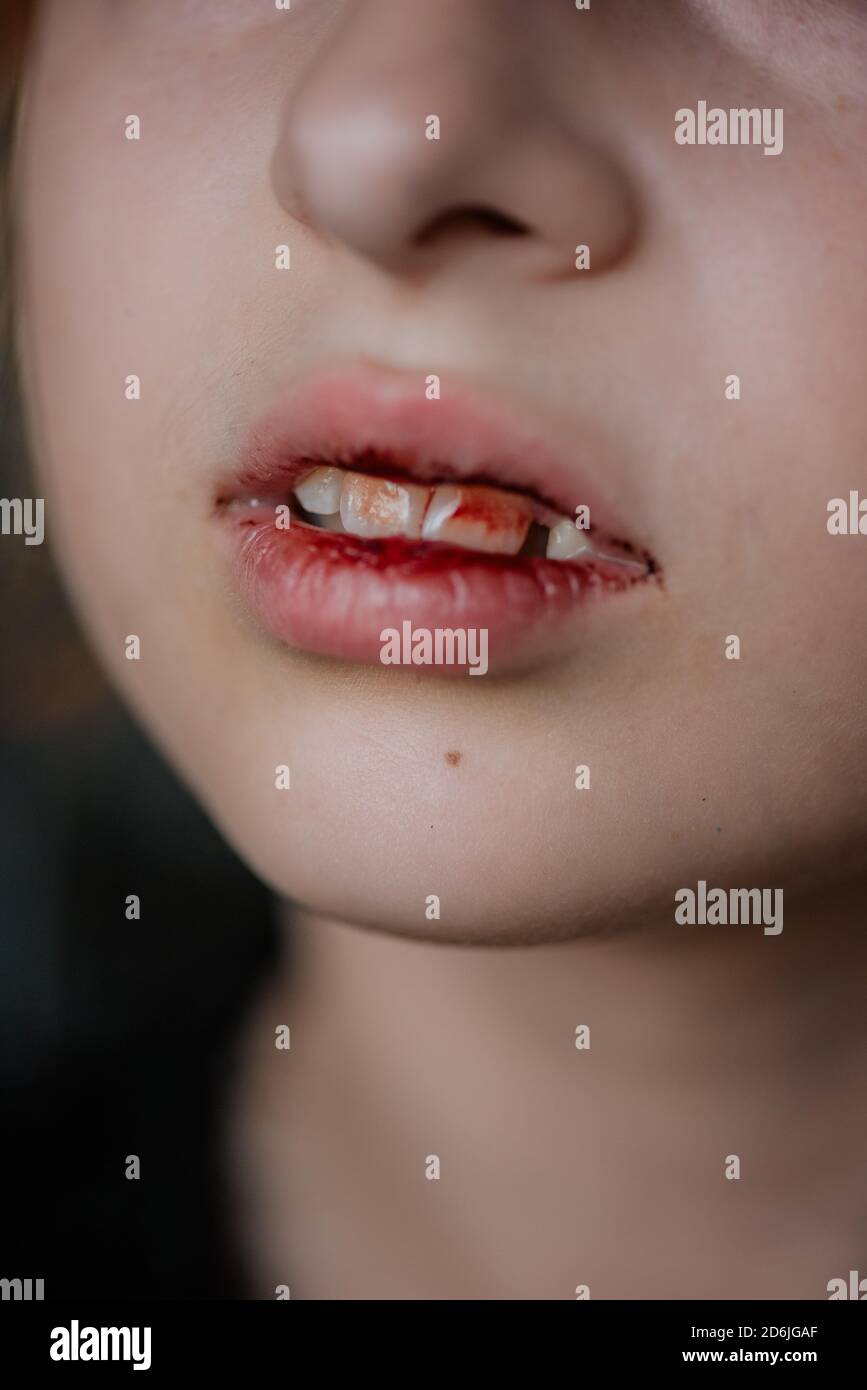 little girl with a broken lip. Girl with a broken lip Stock Photo - Alamy