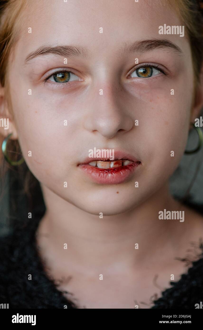 little girl with a broken lip. Girl with a broken lip Stock Photo - Alamy