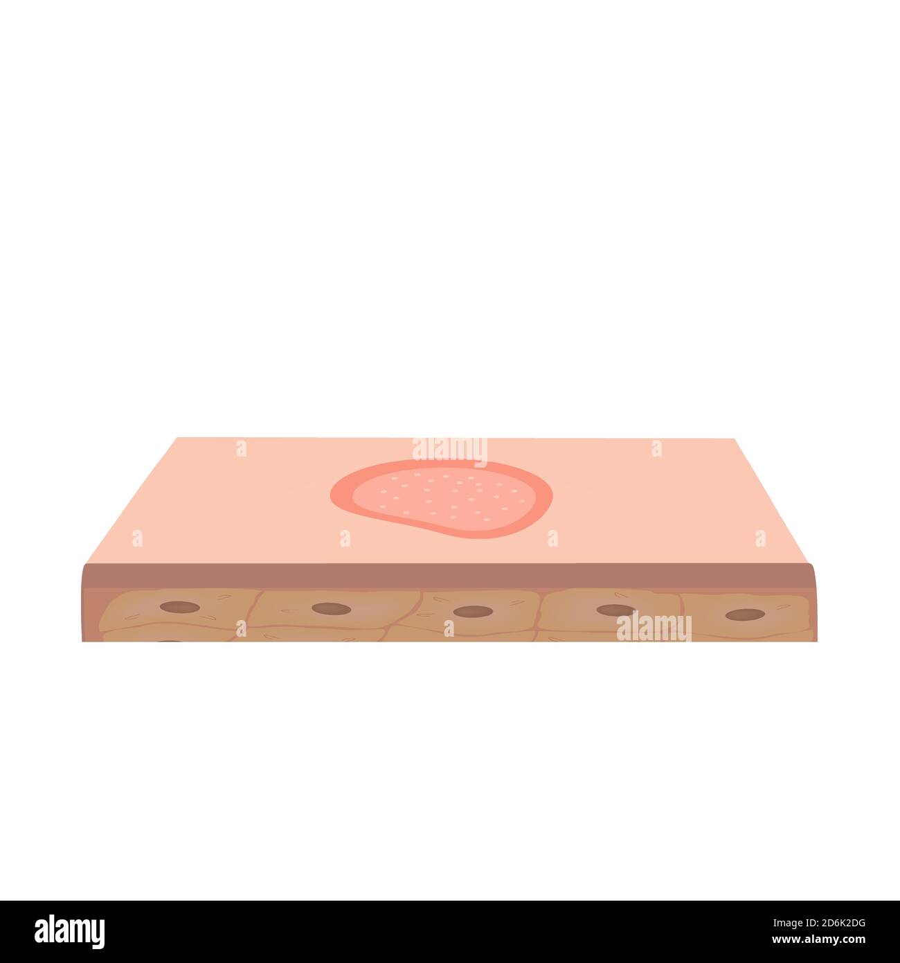 Tinea versicolor hi-res stock photography and images - Alamy