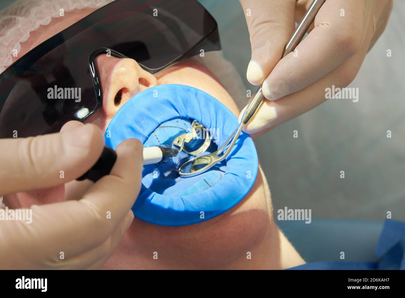 Patient getting dental treatment at dentist office with dental rubber ...
