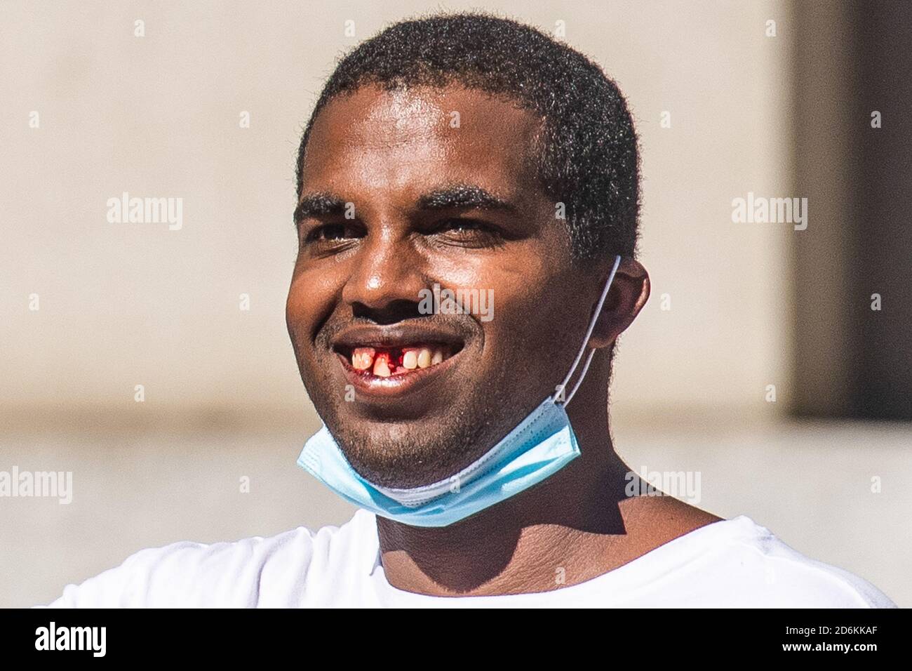 Philip Anderson shows the damage to his teeth after he was punched by ...