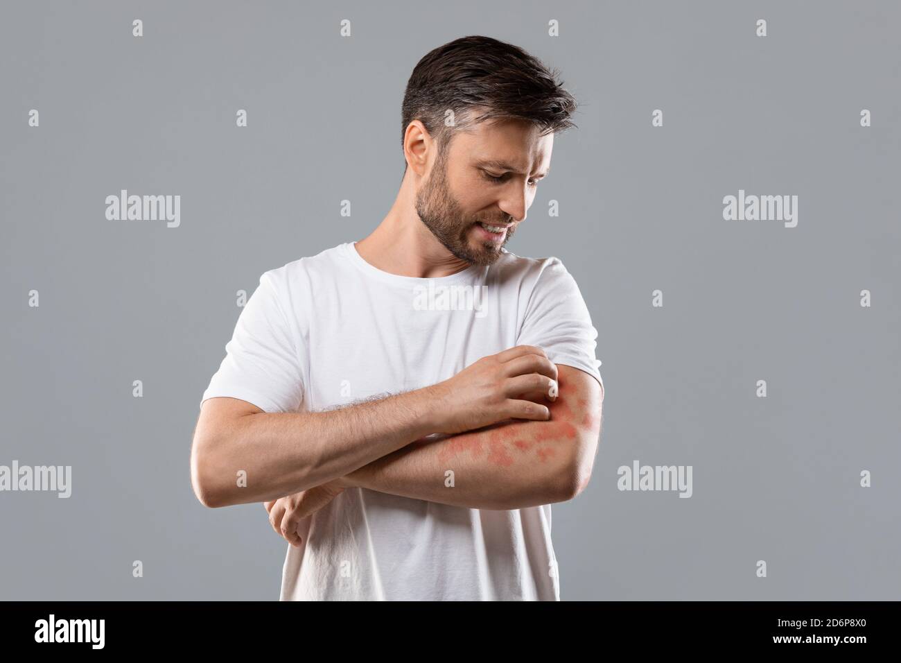 Fungal infection skin arm hi-res stock photography and images - Alamy