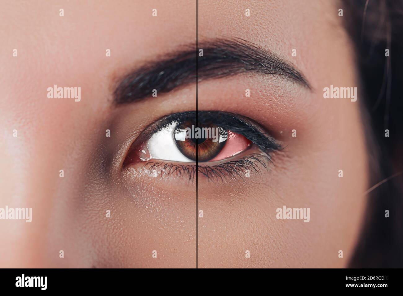 Sick female eye close up, eye treatment Stock Photo - Alamy
