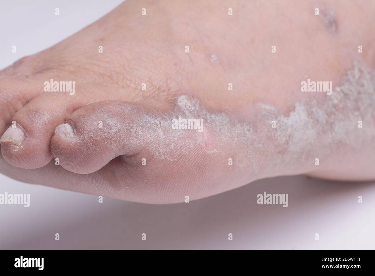 Closeup of the legs of a woman suffering from chronic psoriasis on a ...