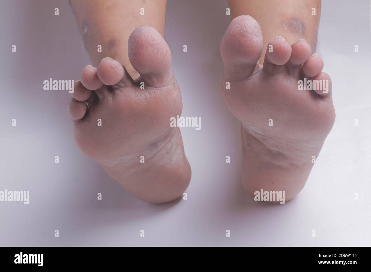 Chronic skin disease hi-res stock photography and images - Alamy