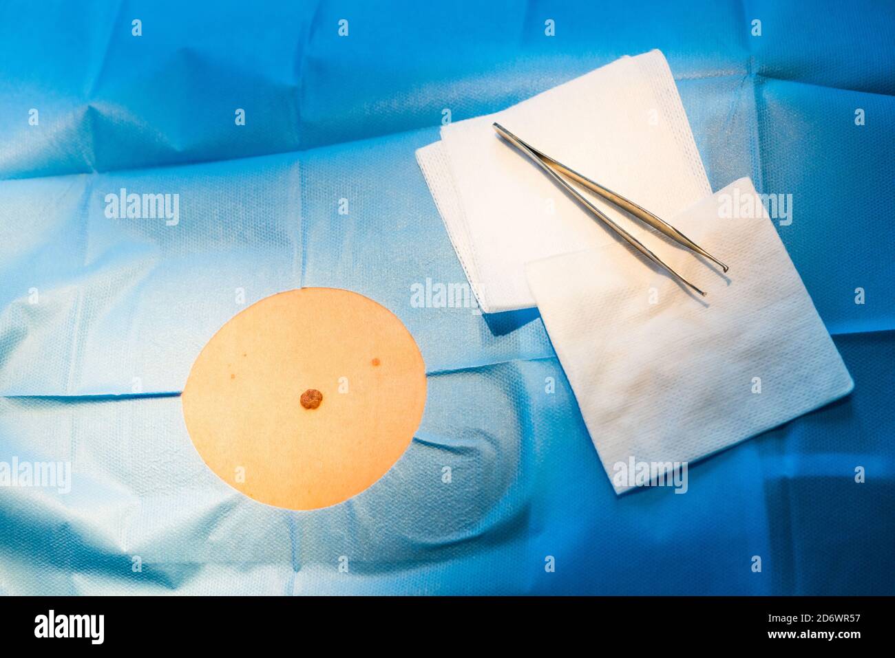 Field of operation, removal of a mole Stock Photo - Alamy