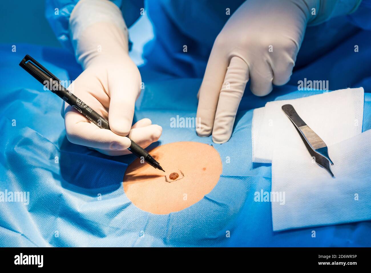 Field of operation, removal of a mole Stock Photo - Alamy