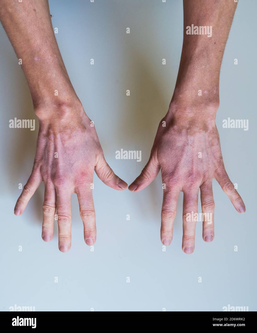 View of vitiligo, skin pigment loss, in the hands of a 35 year old ...