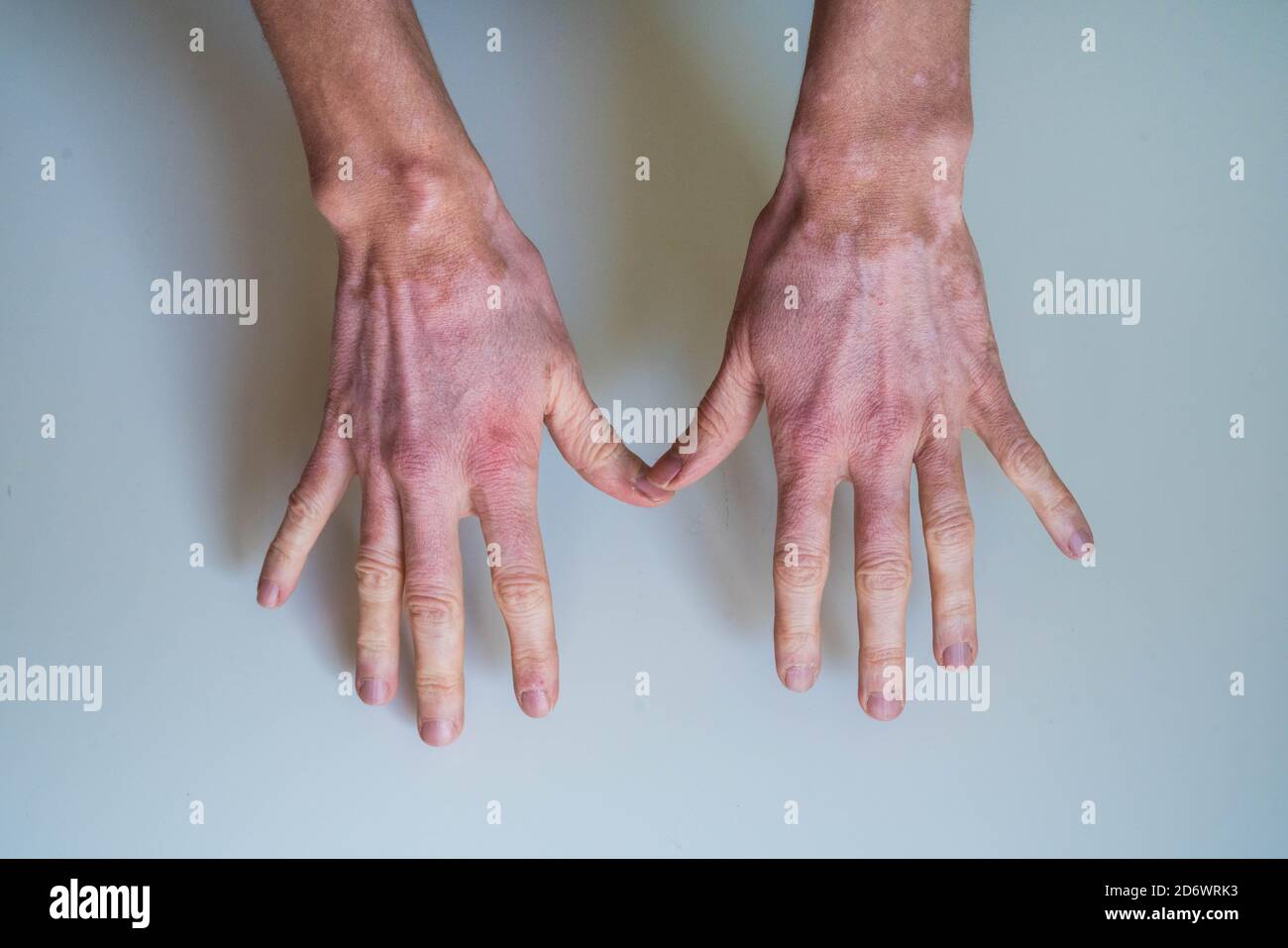 View of vitiligo, skin pigment loss, in the hands of a 35 year old ...