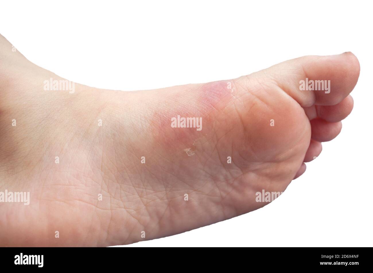 Wound foot child hi-res stock photography and images - Alamy