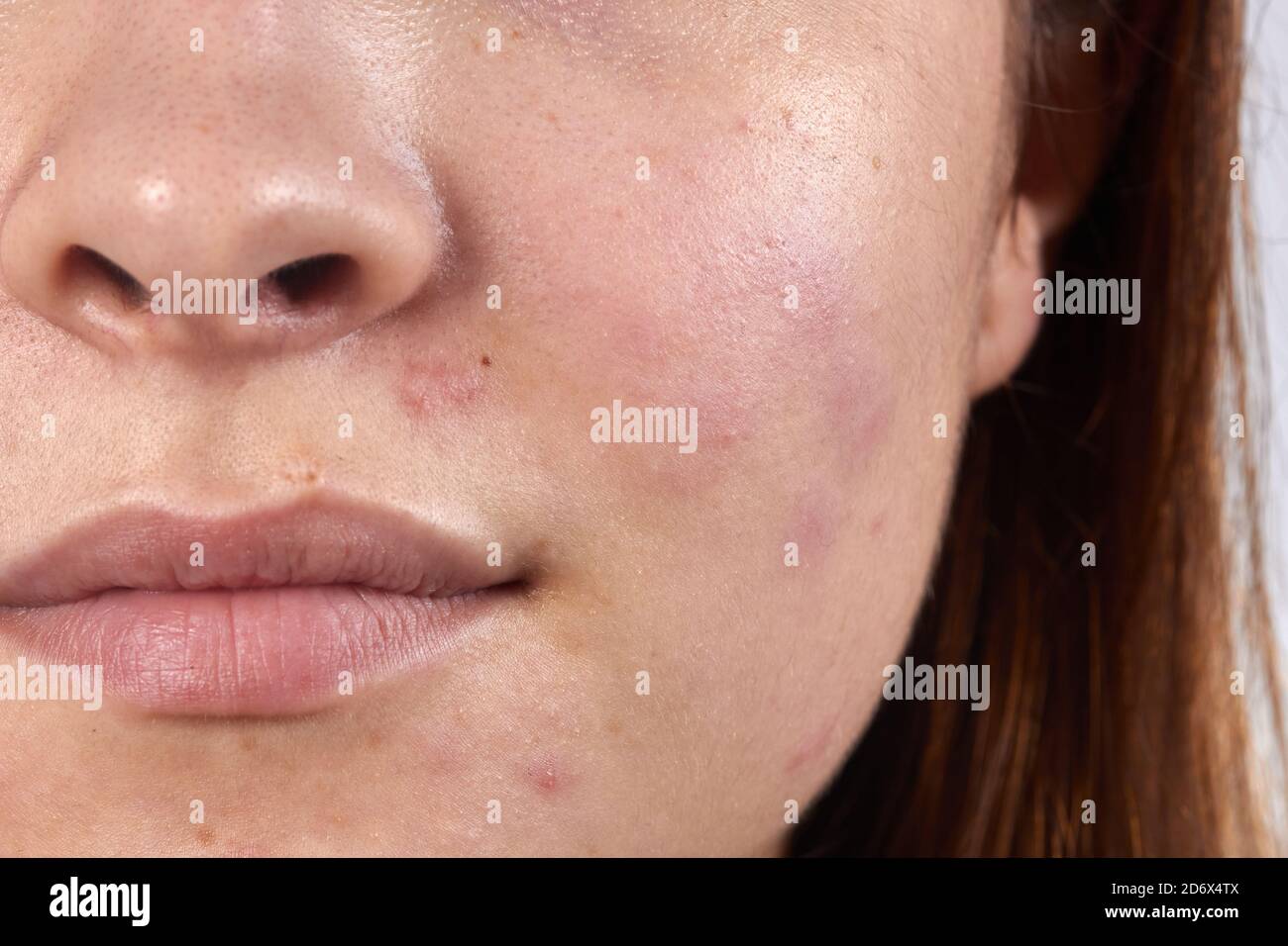 face close-up of redness and pimples skin cleansing Stock Photo - Alamy