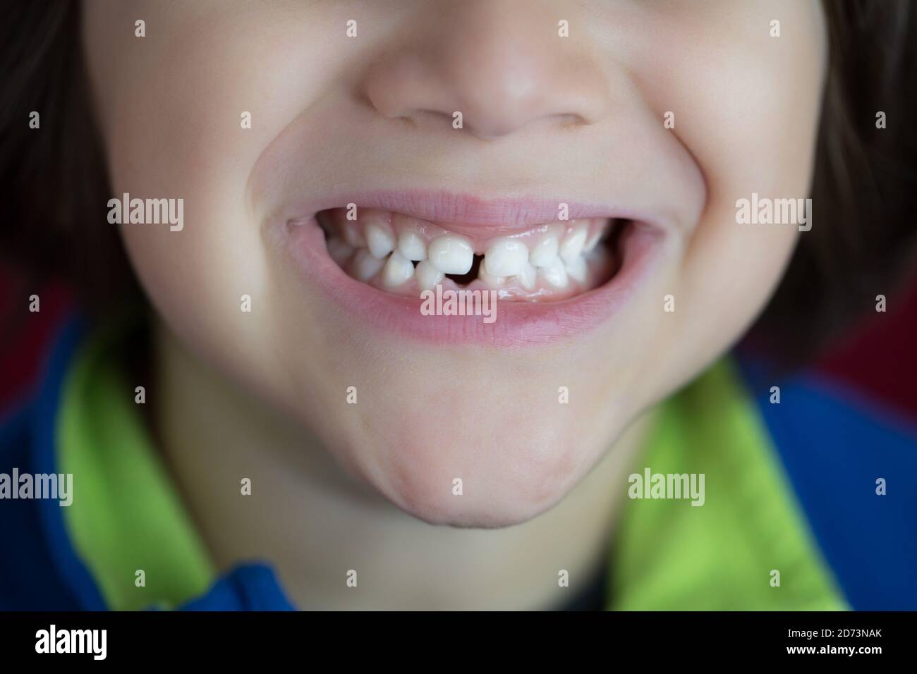 fall of the baby's first tooth close up Stock Photo - Alamy