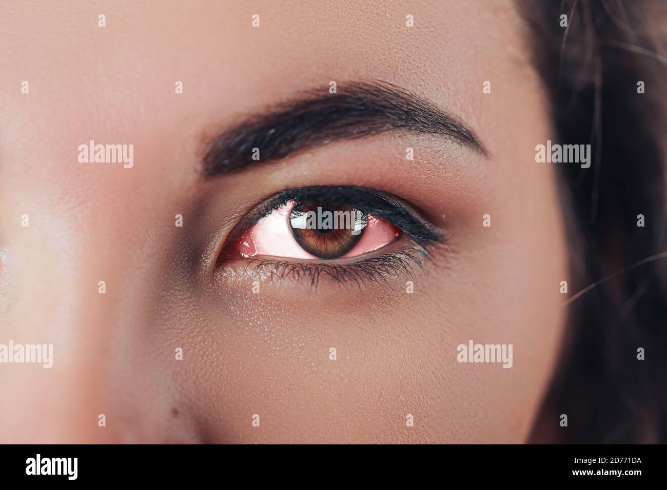 Sick female eye close up, eye treatment Stock Photo - Alamy