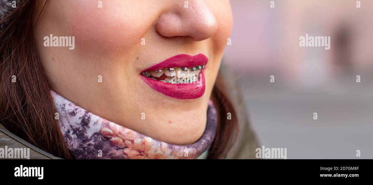 brasket system in smiling mouth, macro photo teeth, close-up lips Stock ...