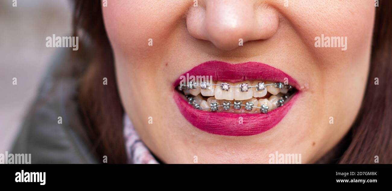 brasket system in smiling mouth, macro photo teeth, close-up lips Stock ...