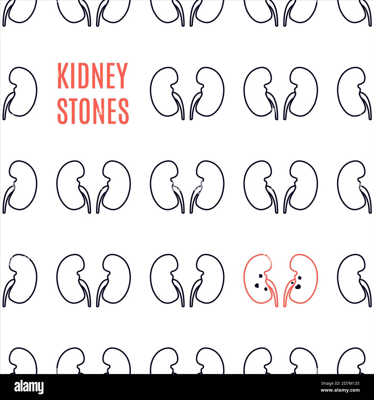 Kidney stone hi-res stock photography and images - Alamy