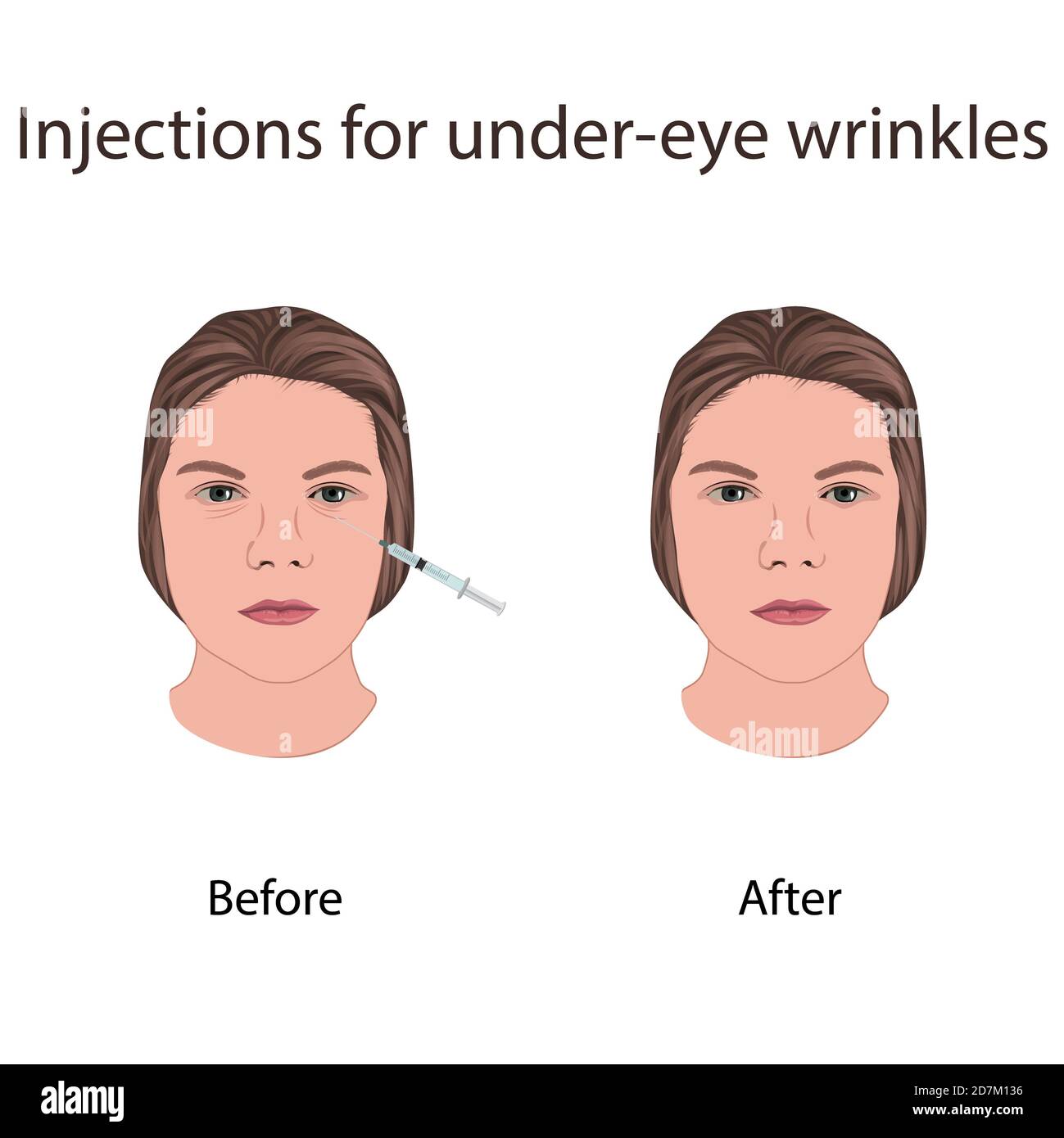 Injections under skin injection hi-res stock photography and images - Alamy