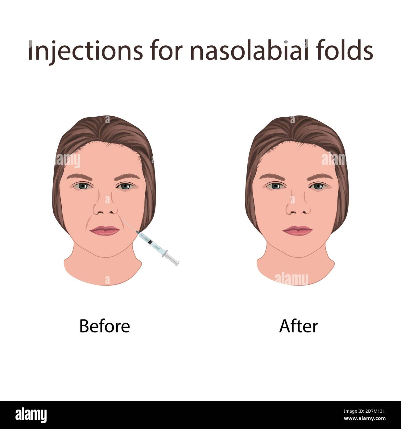 Woman's face before and after injections for nasolabial folds ...