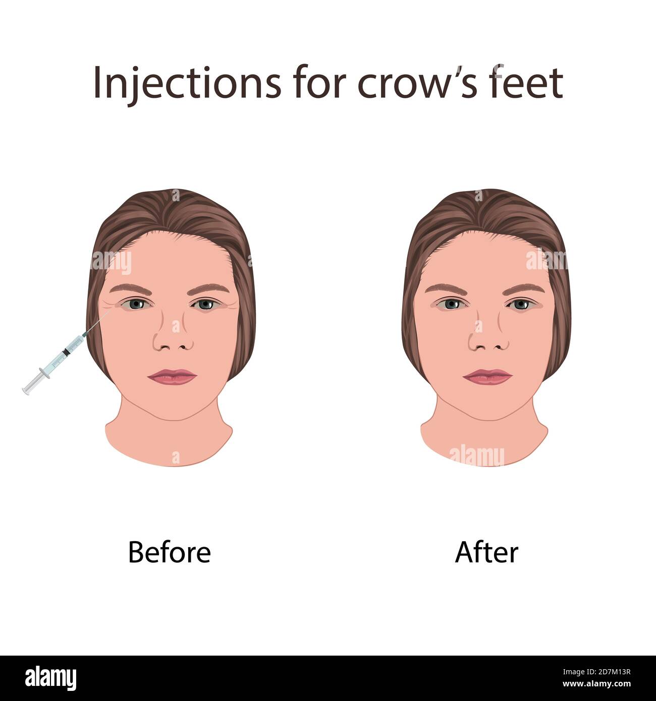 Woman's face before and after injections for crow's feet, illustration ...