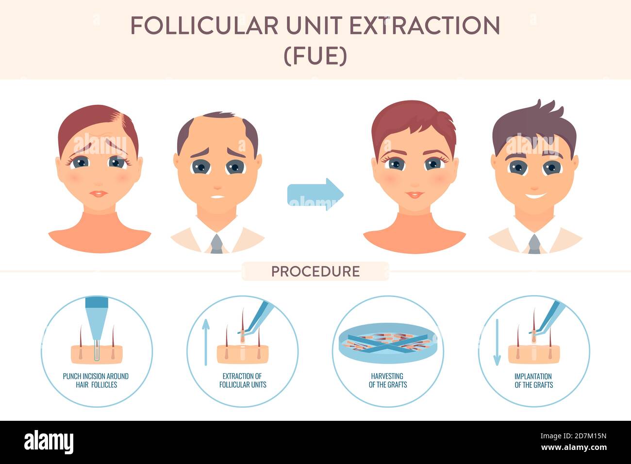 Follicular Unit Extraction Fue Surgery Conceptual Illustration Stock