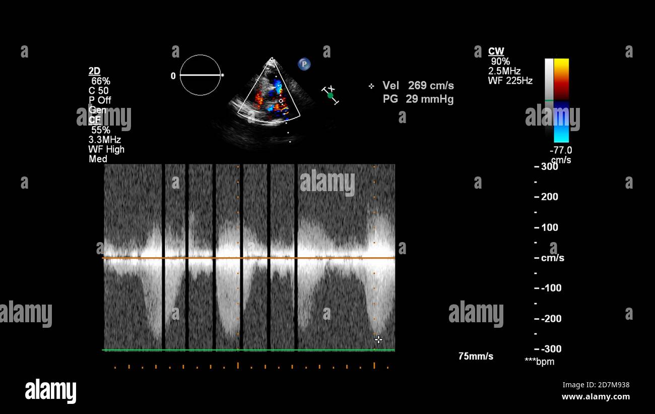 Image of the heart during transesophageal ultrasound with Doppler mode ...