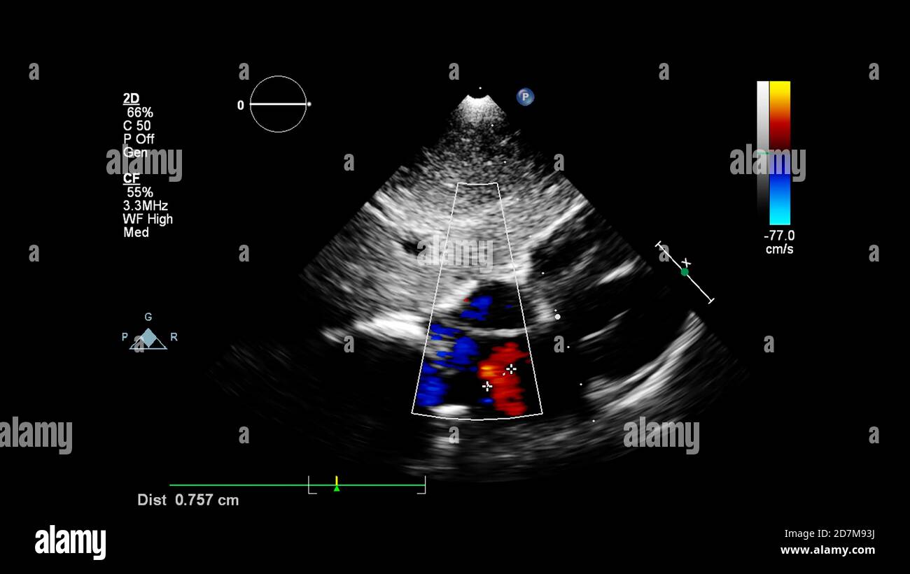 Image of the heart during transesophageal ultrasound with Doppler mode ...