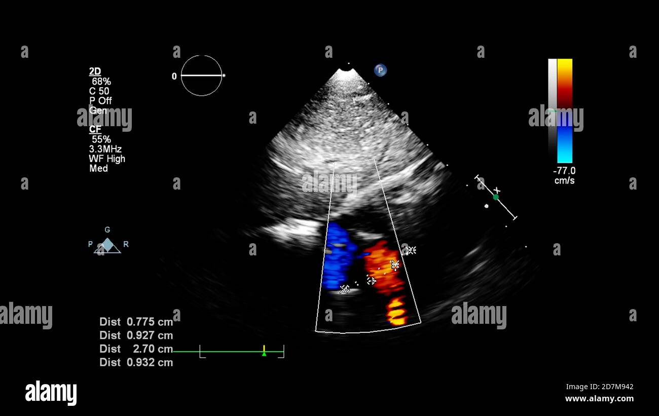 Image of the heart during transesophageal ultrasound with Doppler mode ...