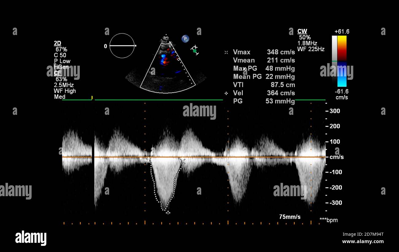 Image of the heart during transesophageal ultrasound with Doppler mode ...
