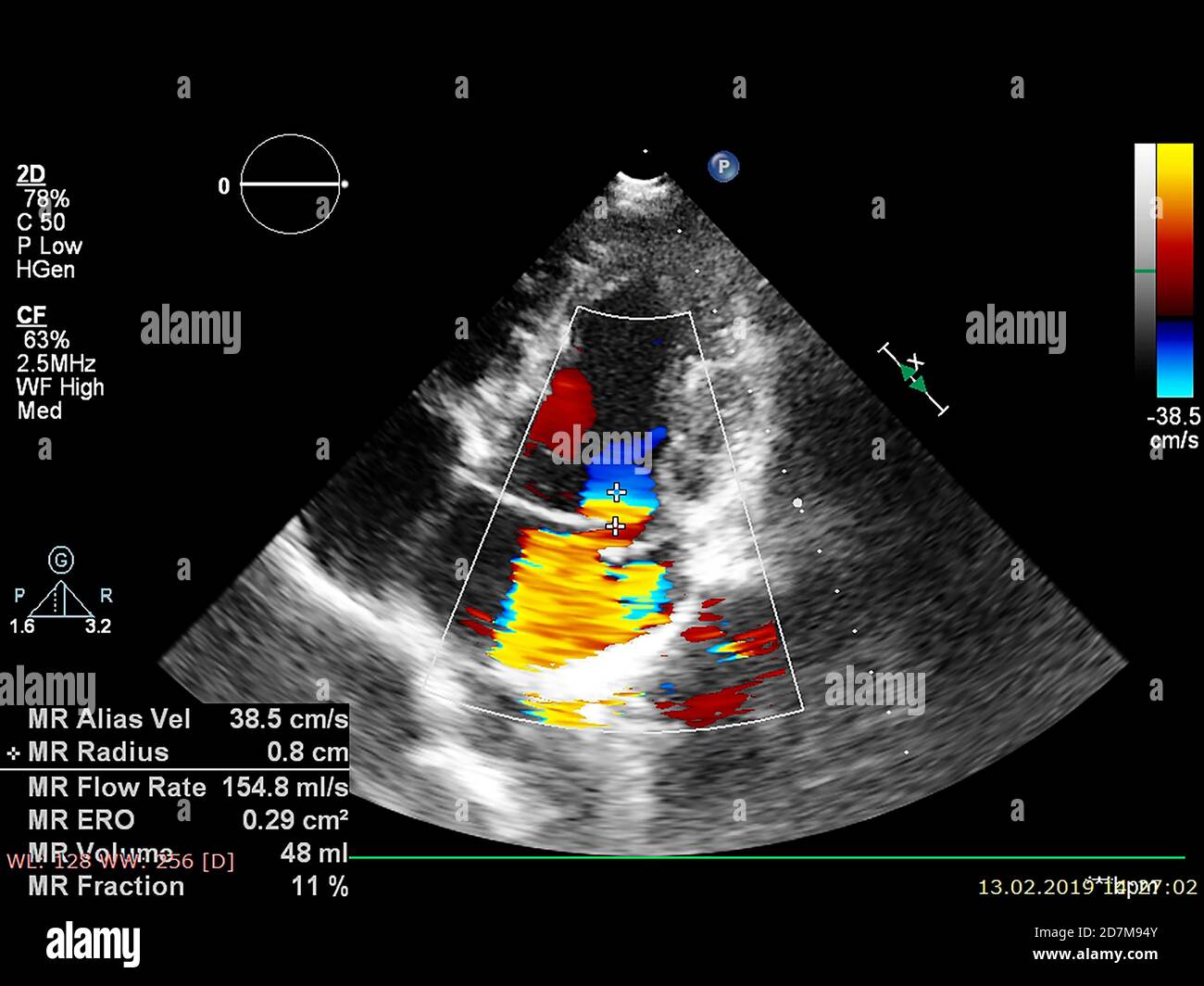 Image of the heart during transesophageal ultrasound with Doppler mode ...