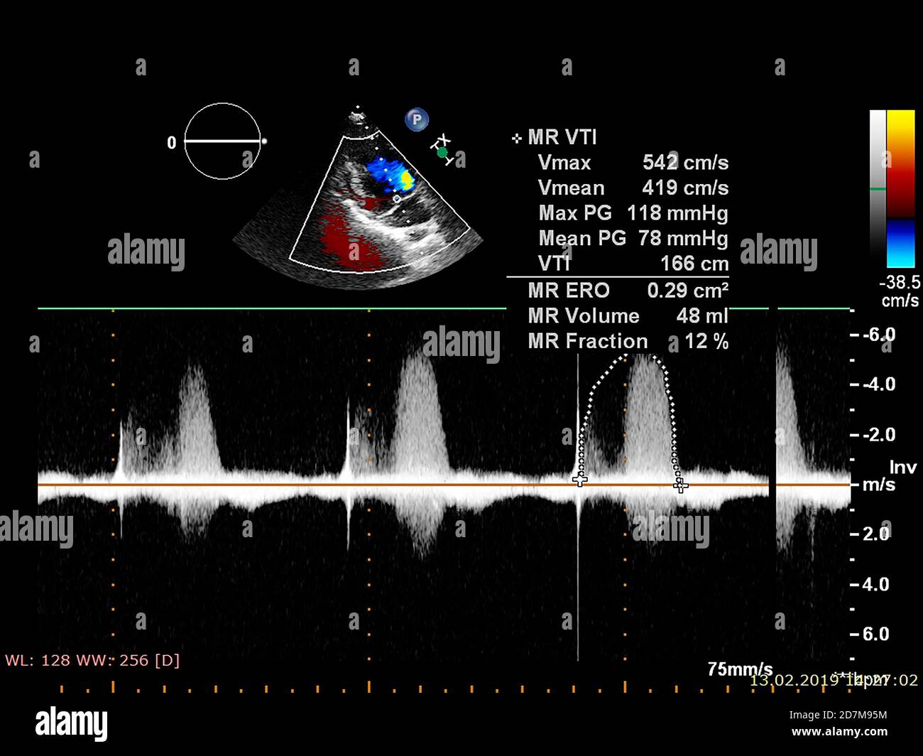 Image of the heart during transesophageal ultrasound with Doppler mode ...