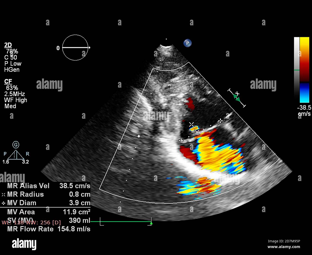 Image of the heart during transesophageal ultrasound with Doppler mode ...