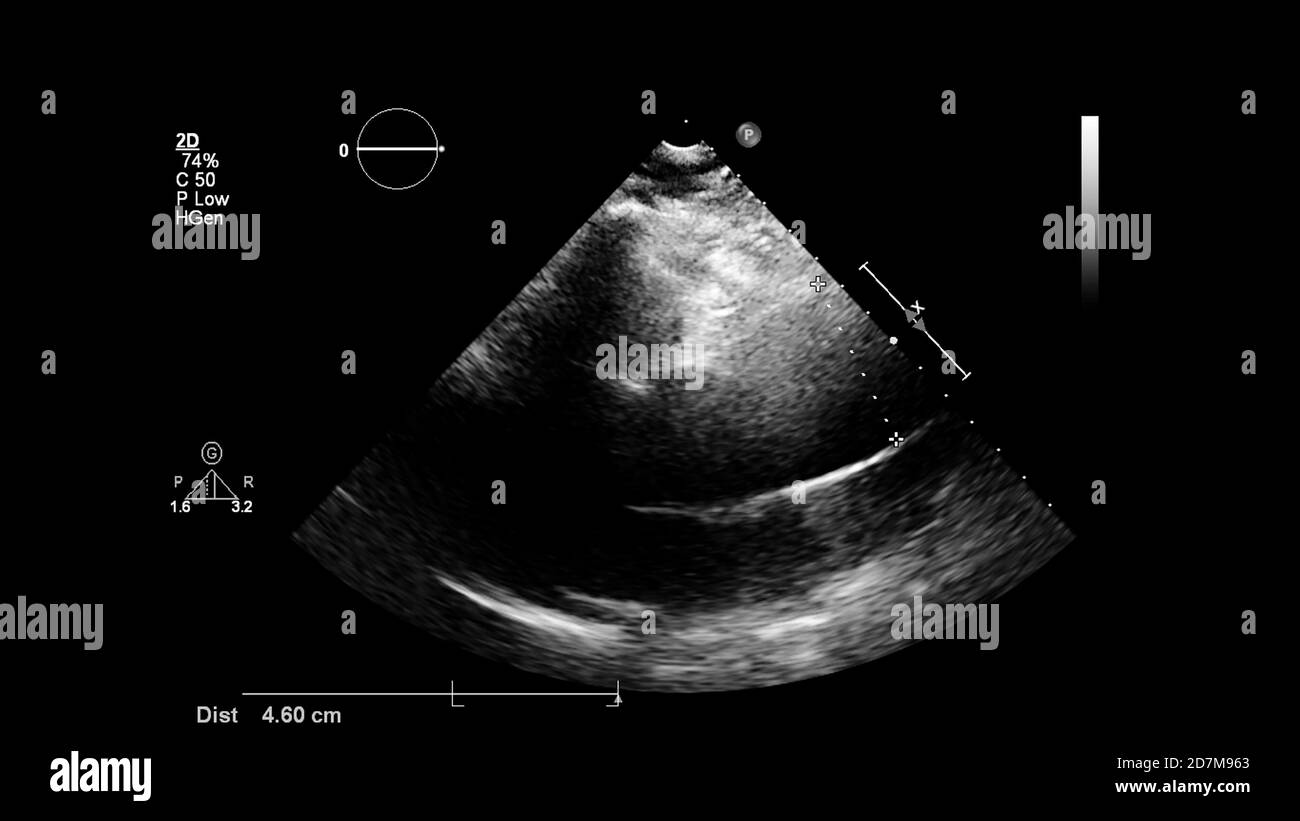 Image of the heart in gray-scale mode during transesophageal ultrasound ...