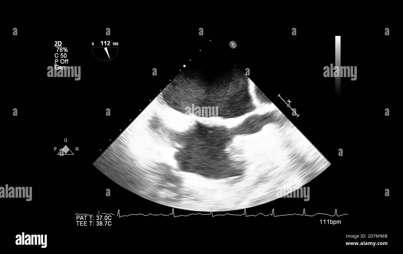 Image of the heart in gray-scale mode during transesophageal ultrasound ...