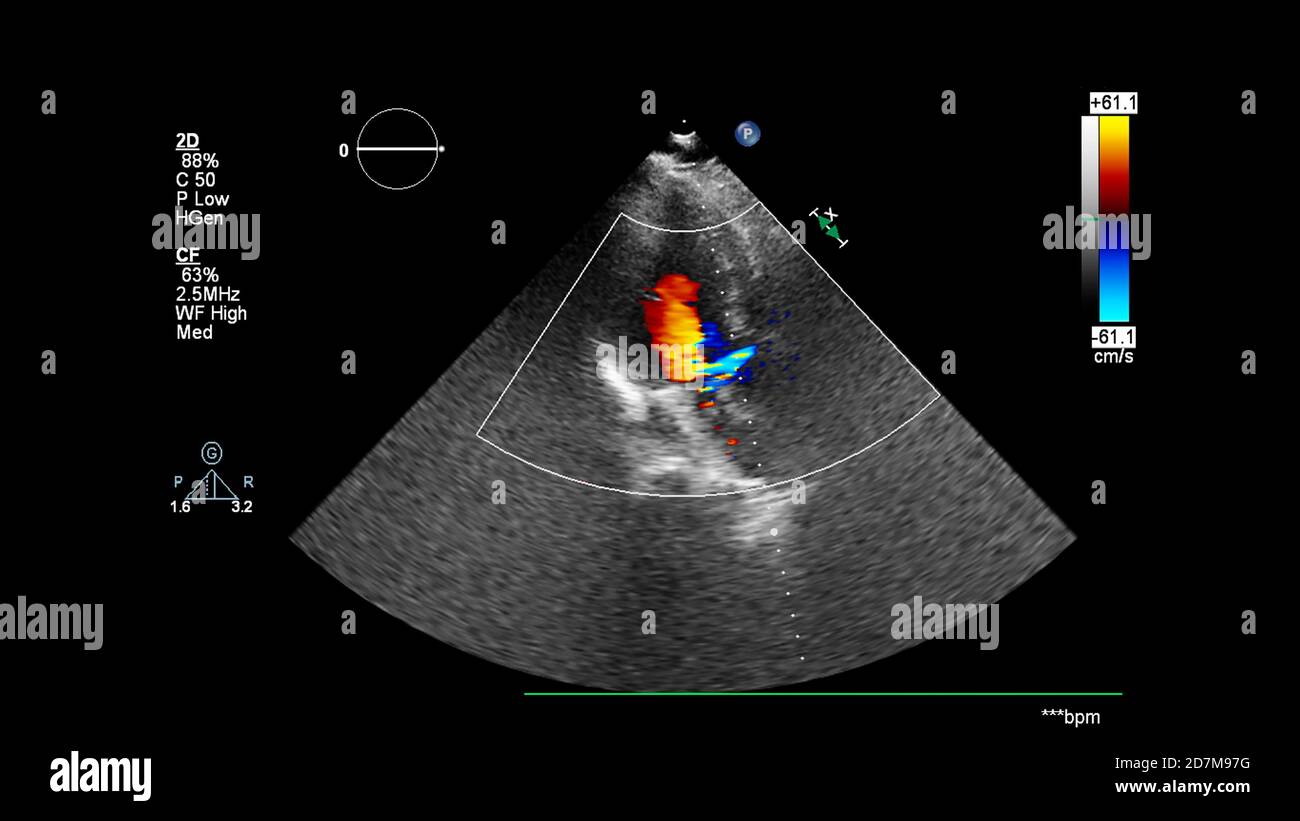 Image of the heart during transesophageal ultrasound with Doppler mode ...