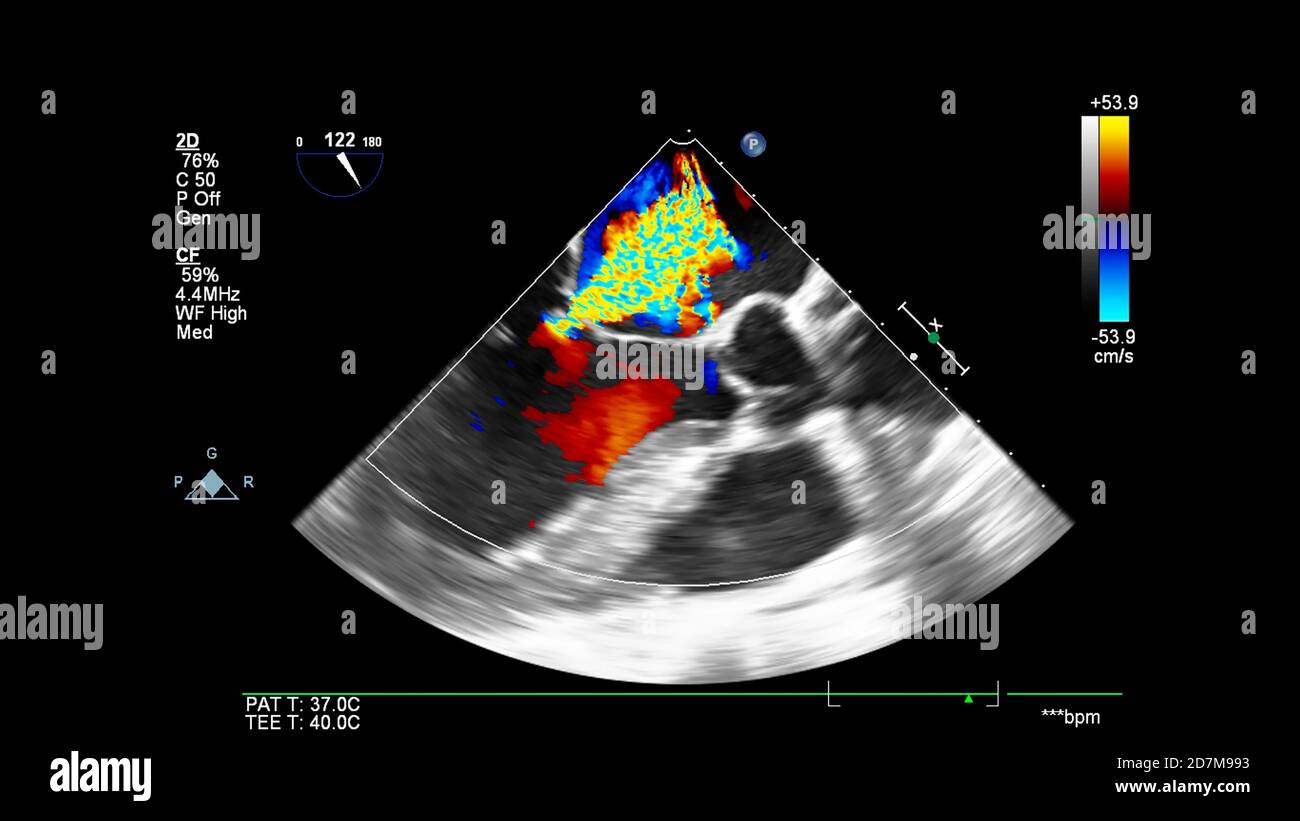 Image of the heart during transesophageal ultrasound with Doppler mode ...