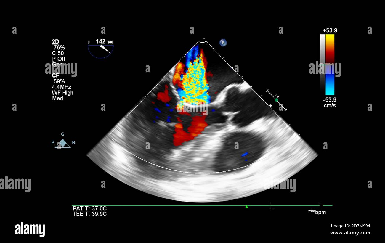 Image of the heart during transesophageal ultrasound with Doppler mode ...