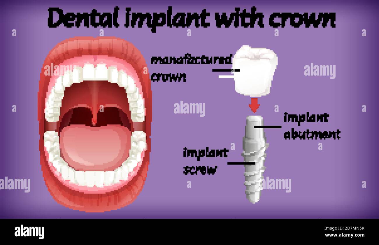 Dental implant with crown illustration Stock Vector Image & Art - Alamy