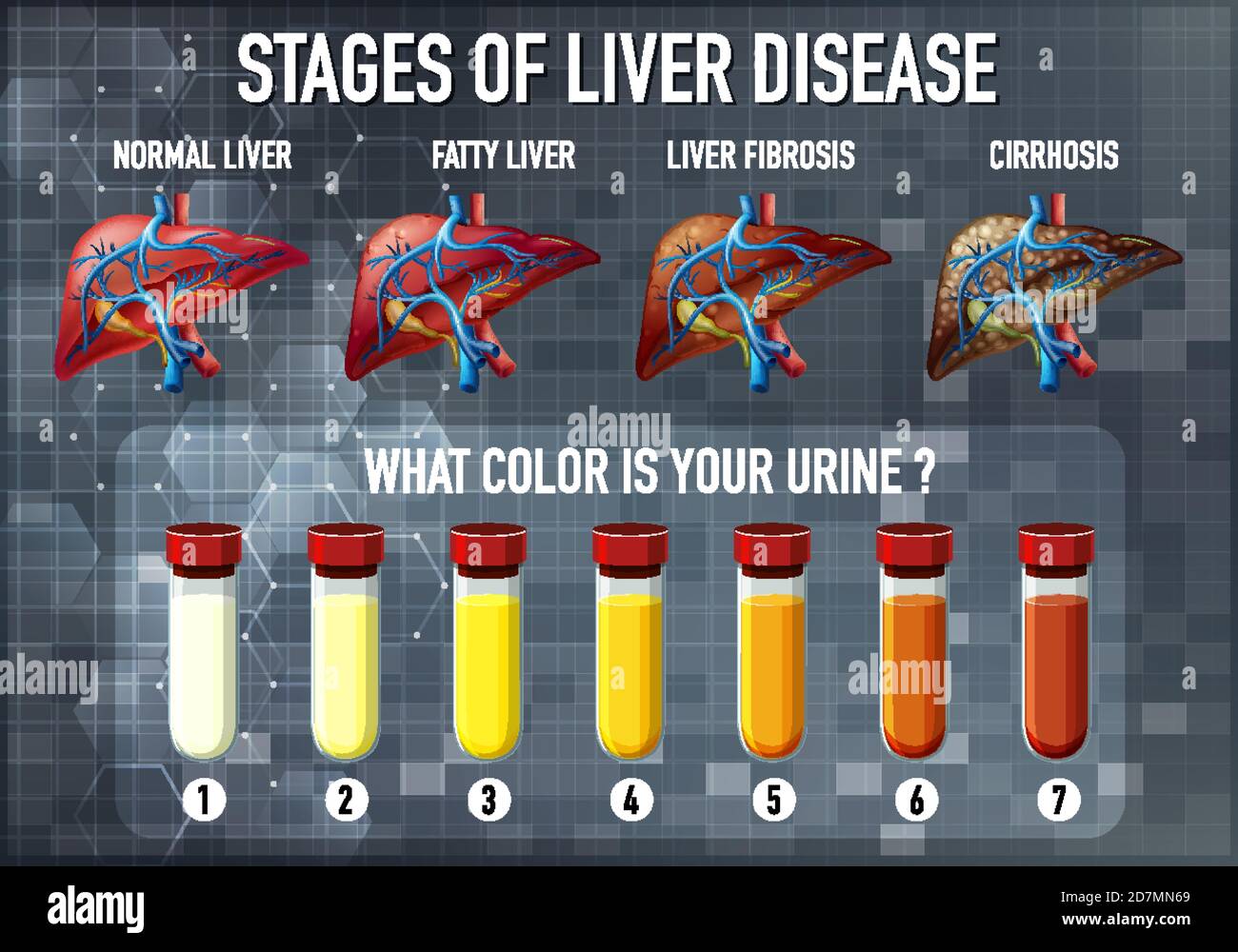 Stages of liver disease illustration Stock Vector Image & Art - Alamy