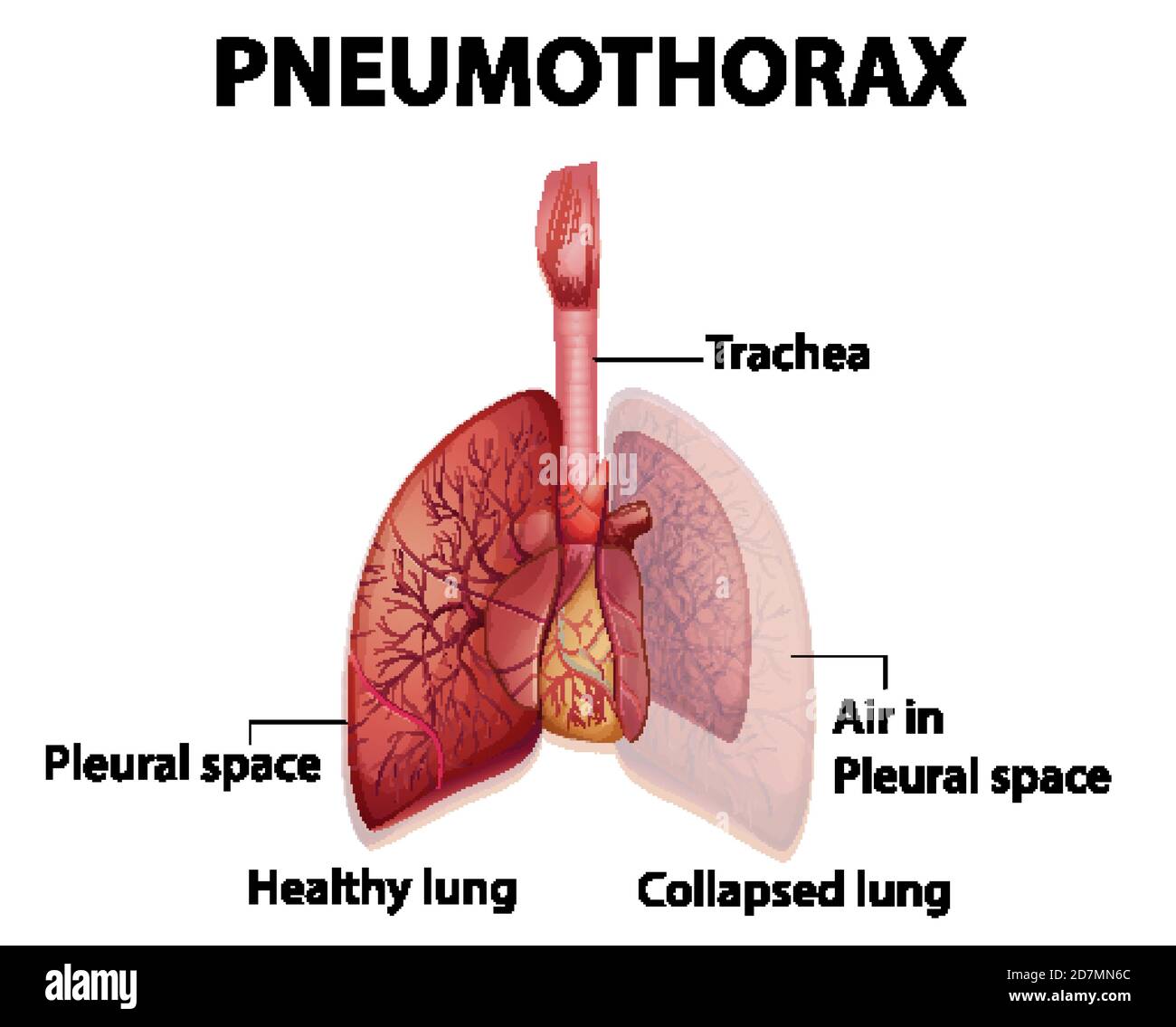 Informative illustration of Pneumothorax illustration Stock Vector ...