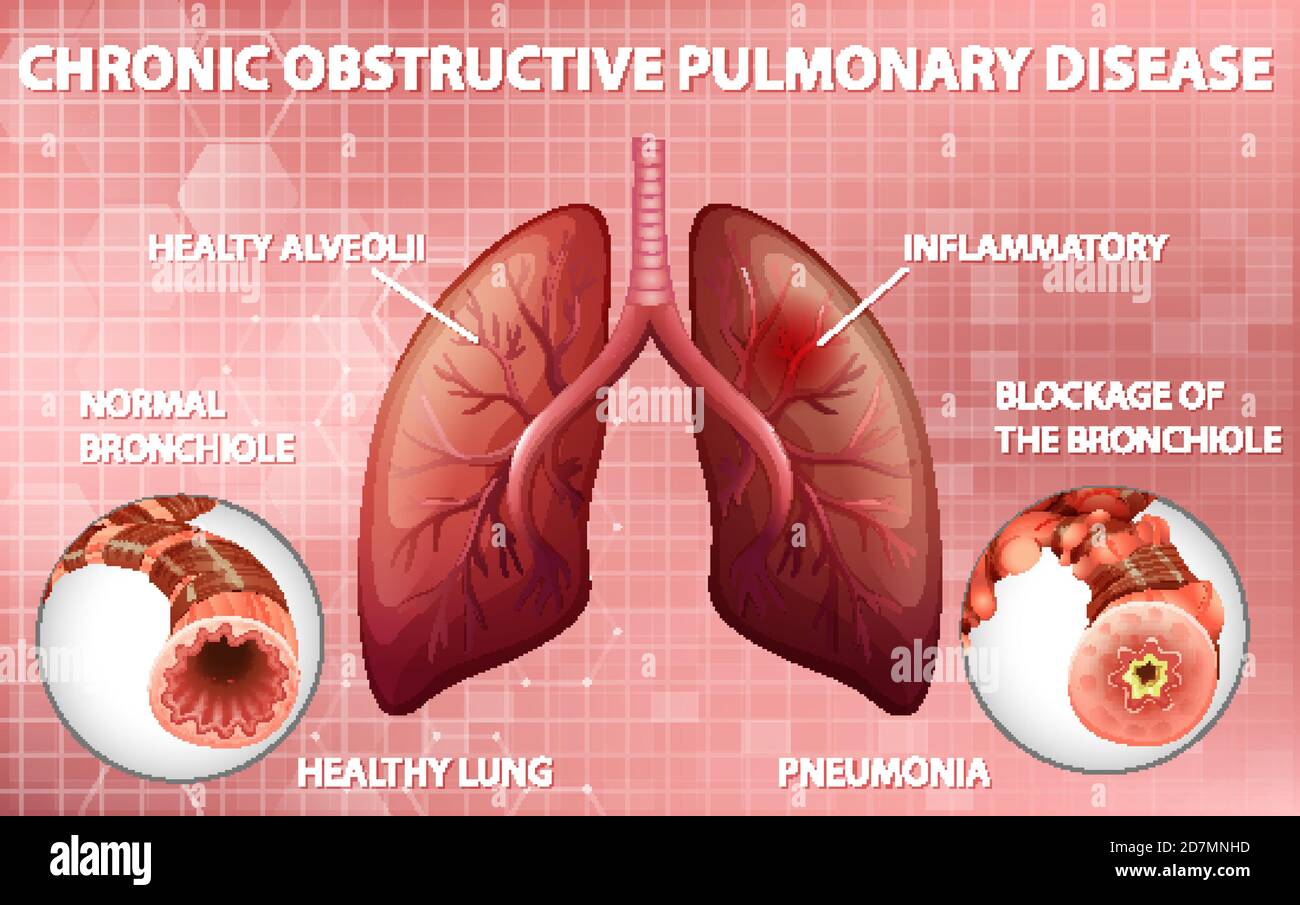 Chronic obstructive pulmonary disease illustration Stock Vector Image ... Chronic obstructive pulmonary disease illustration Stock Vector Image ...