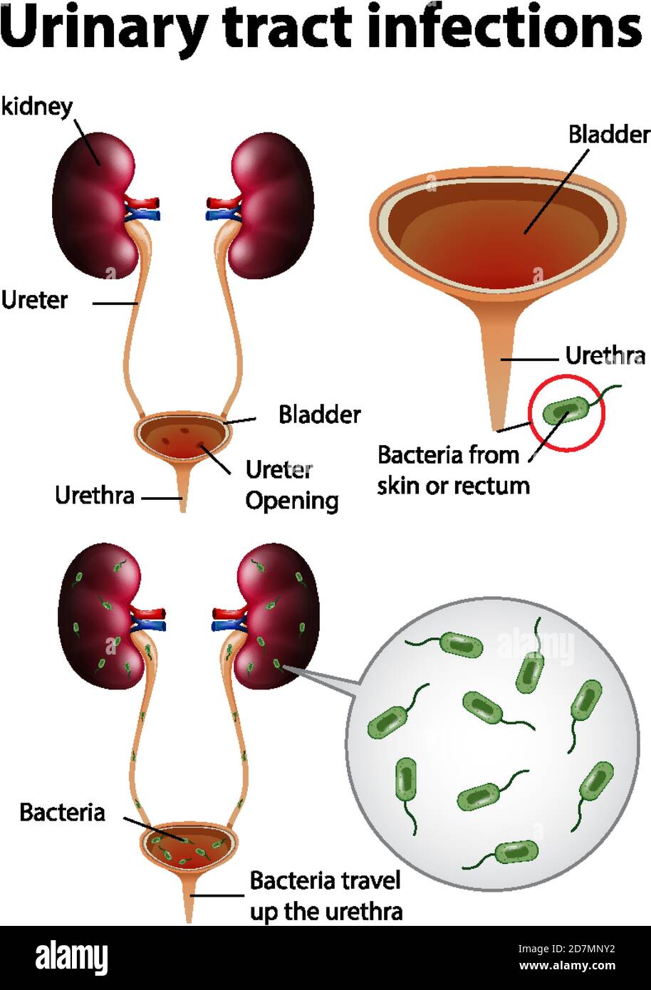 Informative illustration of urinary tract infections illustration Stock ...
