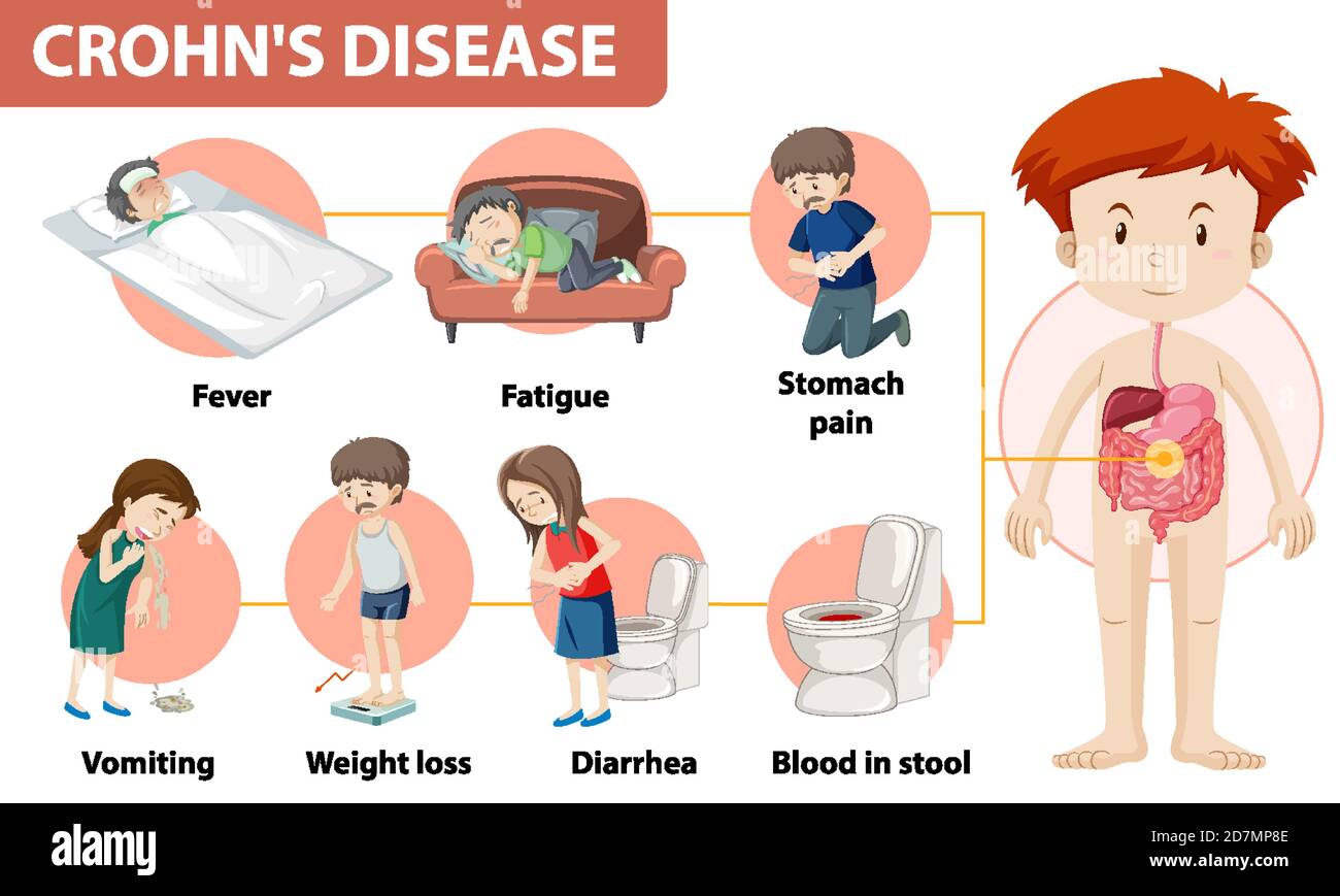 Medical infographic of Crohn's Disease illustration Stock Vector Image ...