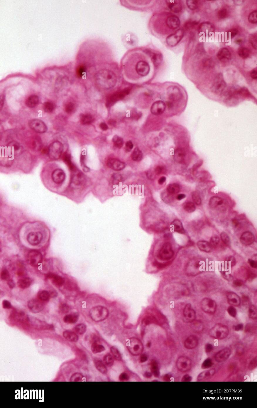 Damaged epithelium hi-res stock photography and images - Alamy