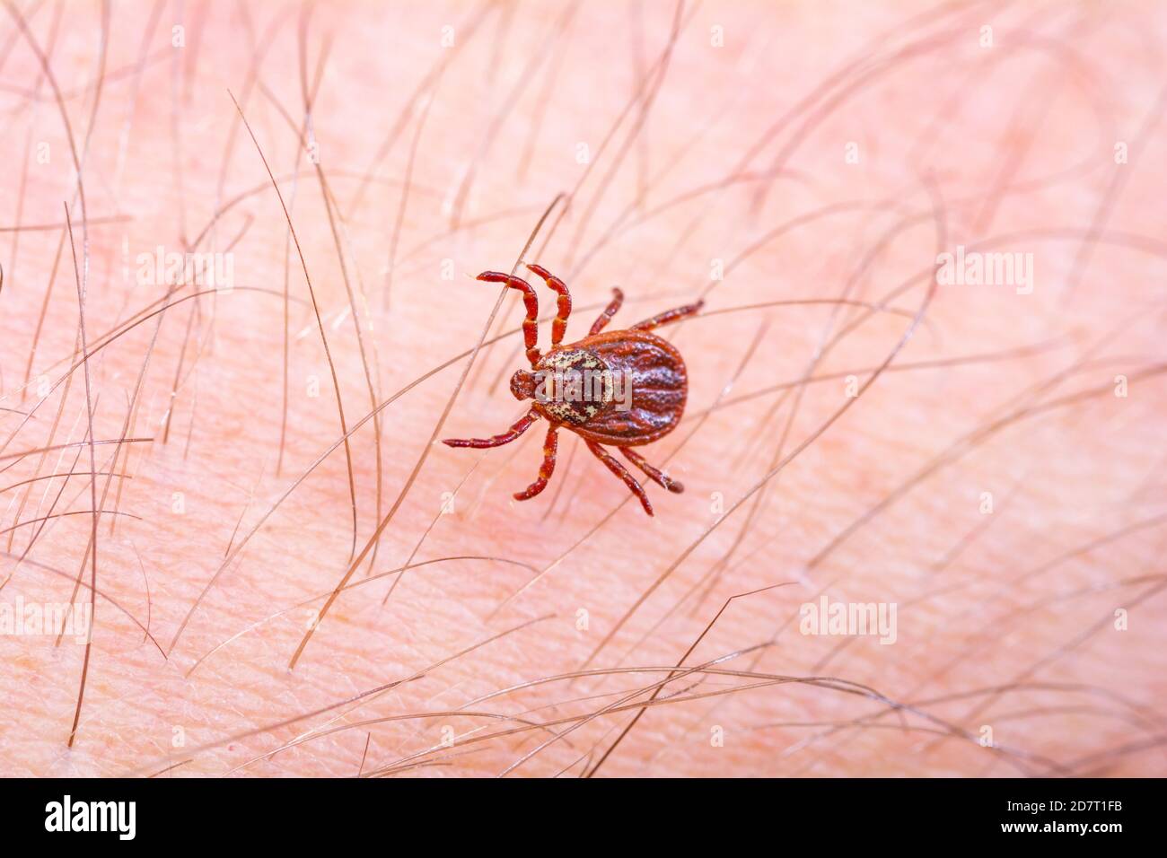 Mite on the skin. Danger of tick bite Stock Photo - Alamy