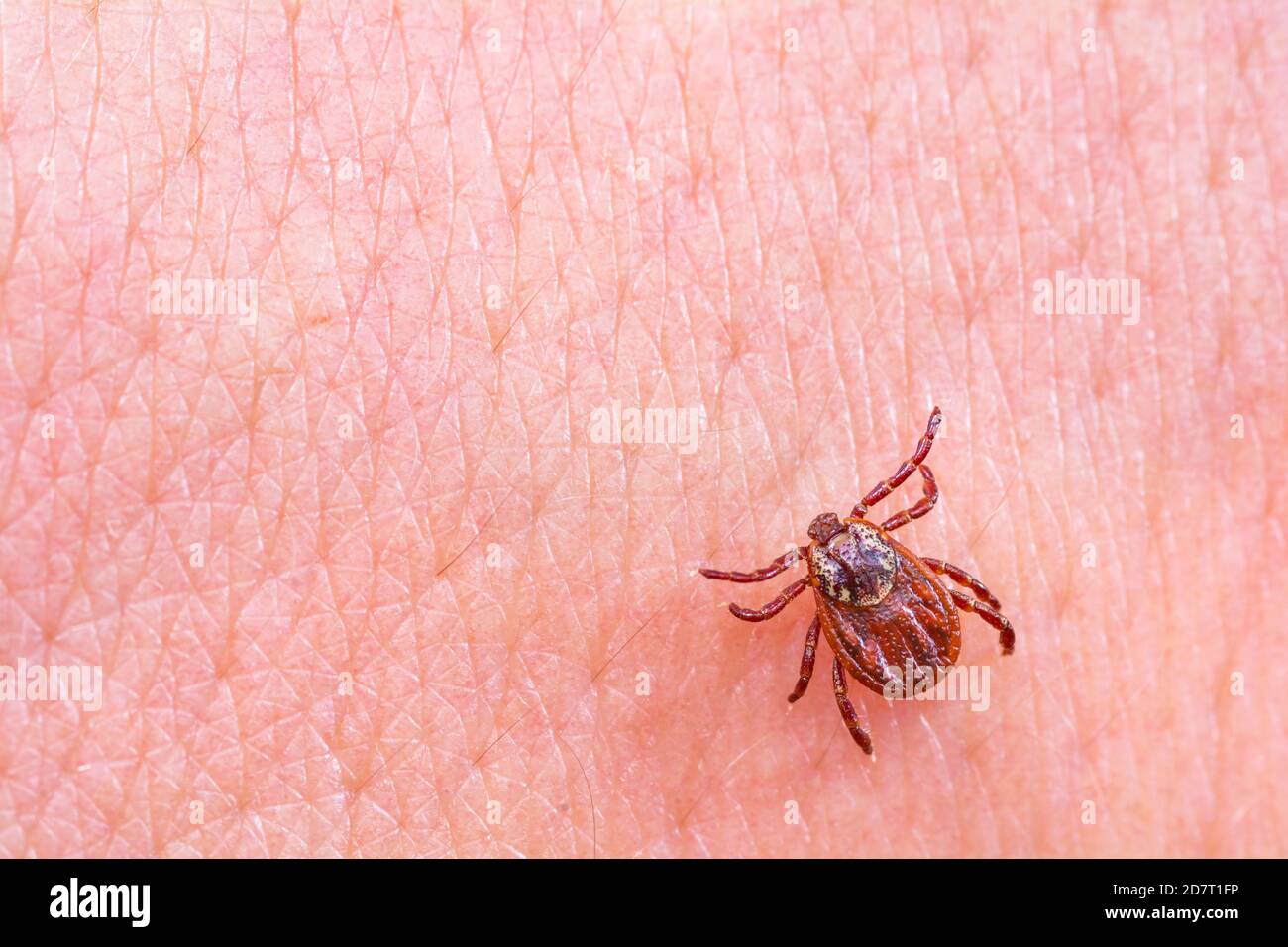 Mite on the skin. Danger of tick bite Stock Photo - Alamy
