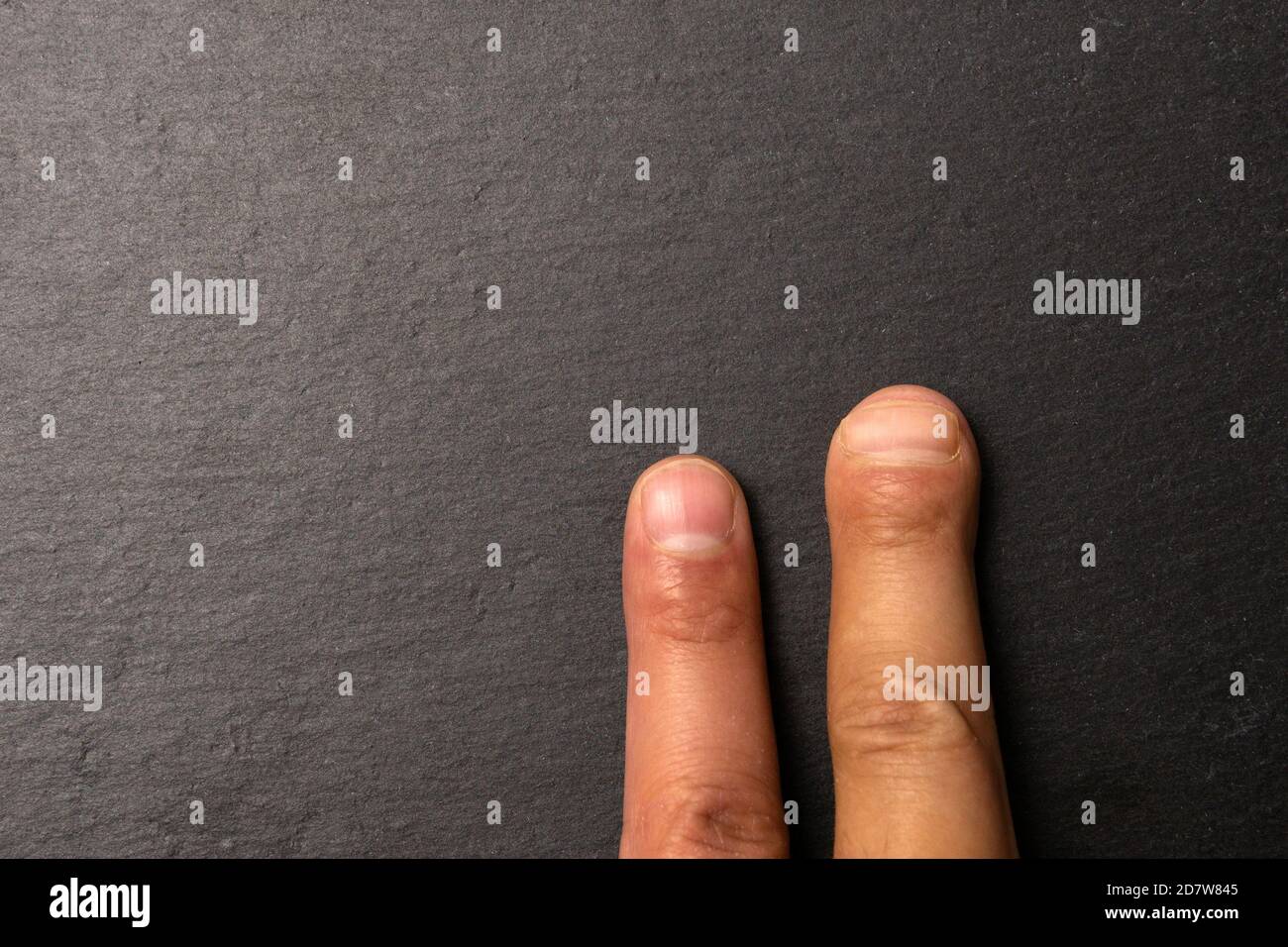 Gangrene hi-res stock photography and images - Alamy