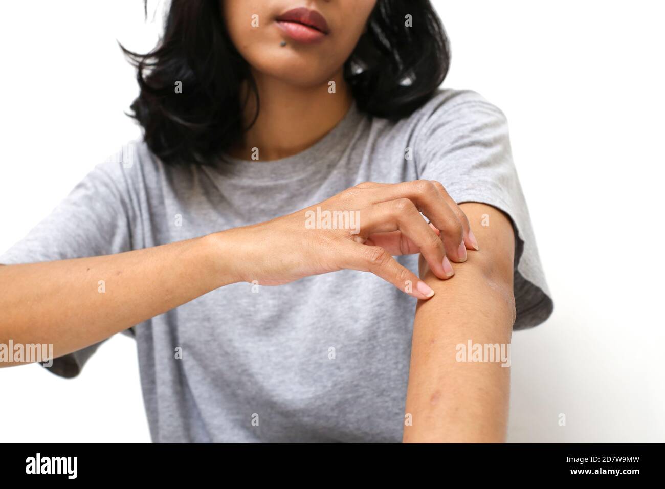 Allergy. Itchy skin. Women's hands are scratched, on white background ...